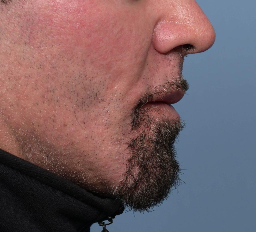 Plastic Surgery Case Study - Male ePTFE Paranasal Implants after Custom ...