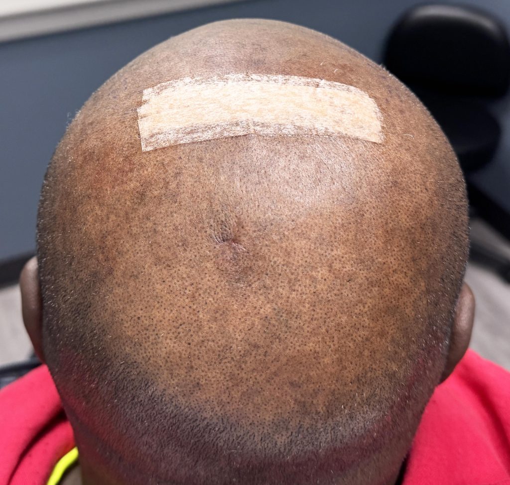 Plastic Surgery Case Study - Skull Reduction of the Sagittal Hump ...