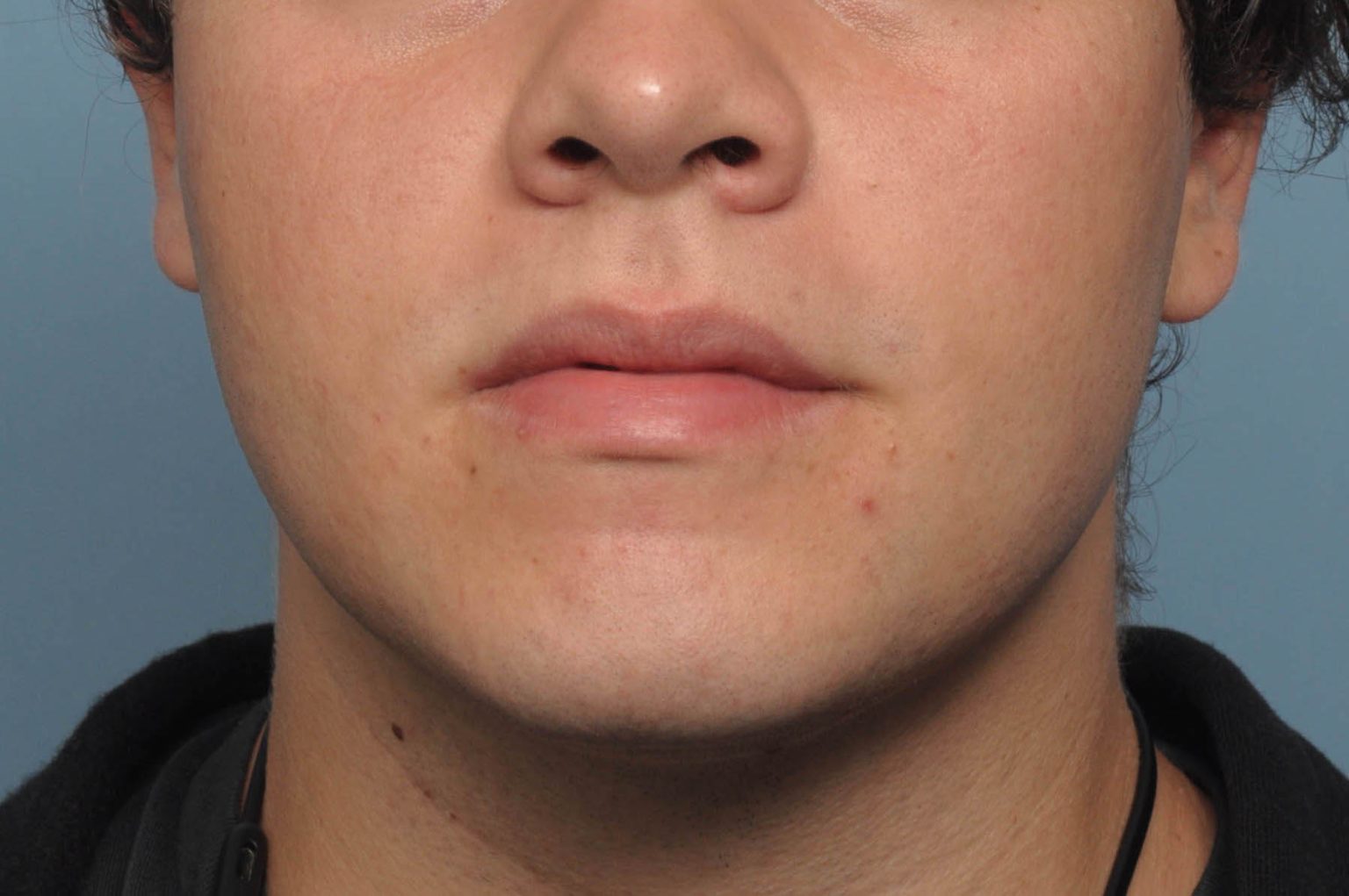 Plastic Surgery Case Study - Strong Jawline Implant Augmentation in the ...