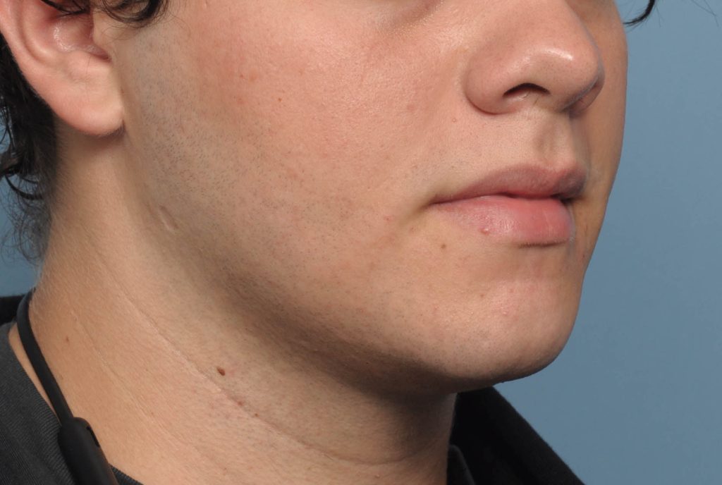 Plastic Surgery Case Study - Strong Jawline Implant Augmentation in the ...