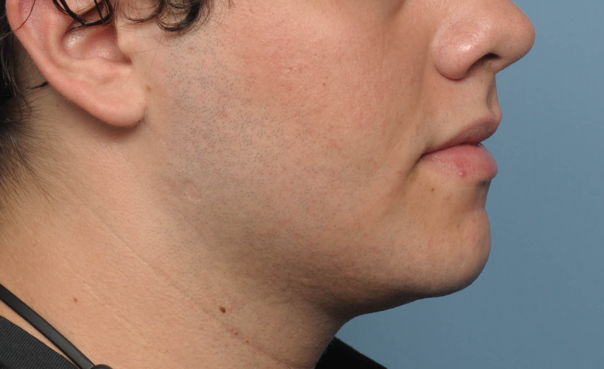 Plastic Surgery Case Study - Strong Jawline Implant Augmentation in the ...