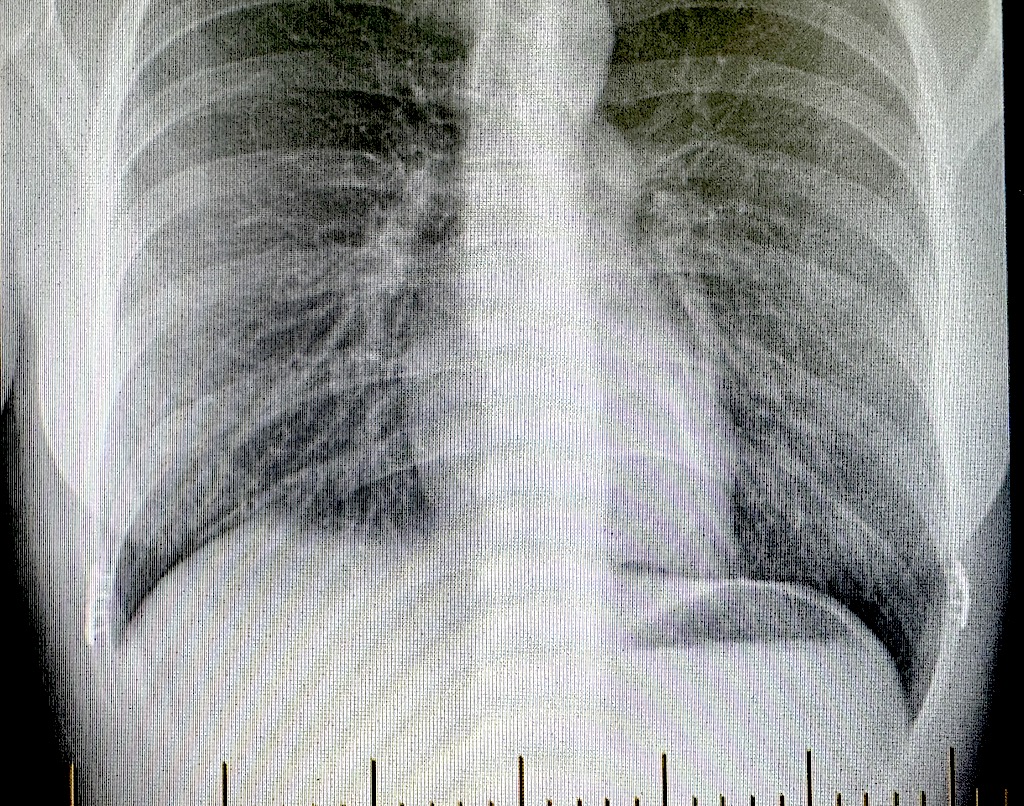 Plastic Surgery Case Study - Rib #9 Osteotomy Shortening in Eight Rib ...