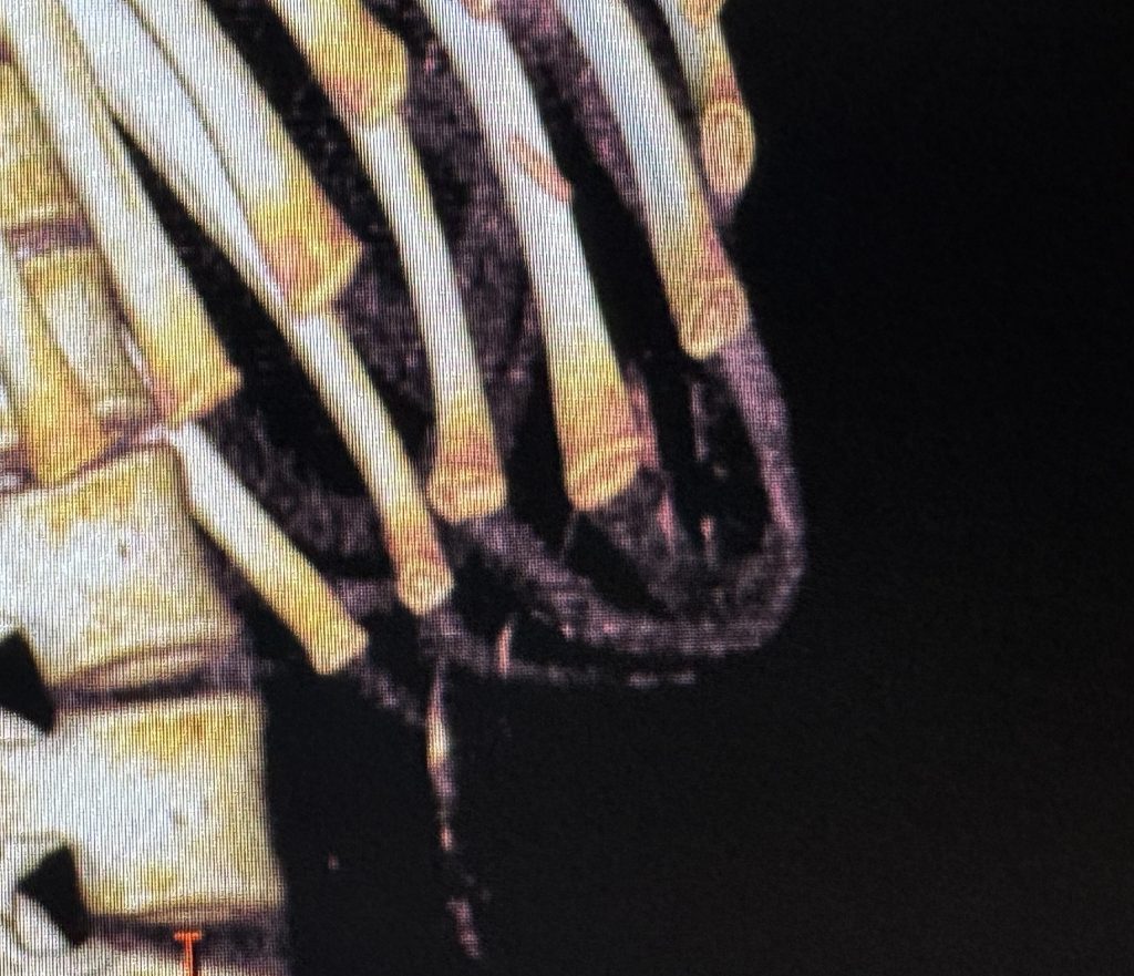 Plastic Surgery Case Study - Rib Remodeling for Right Subcostal Flare ...