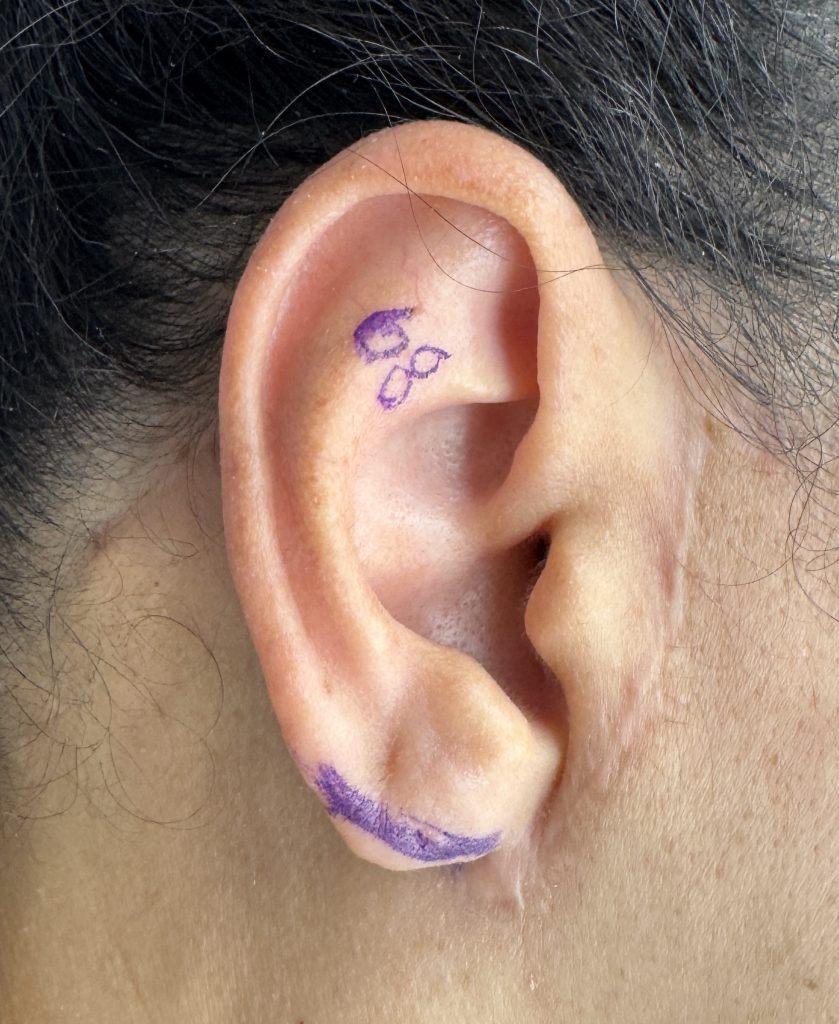Plastic Surgery Case Study - Secondary Ear and Scat Revisions After ...