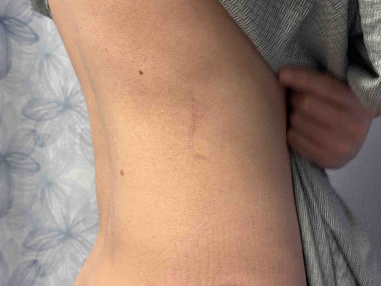 right type 2 rib removal scar Dr Barry Eppley - Explore Plastic Surgery