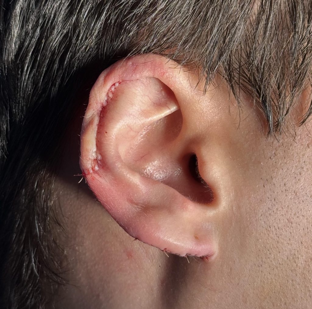 Plastic Surgery Case Study - Male Vertical Ear Reductions - Explore ...