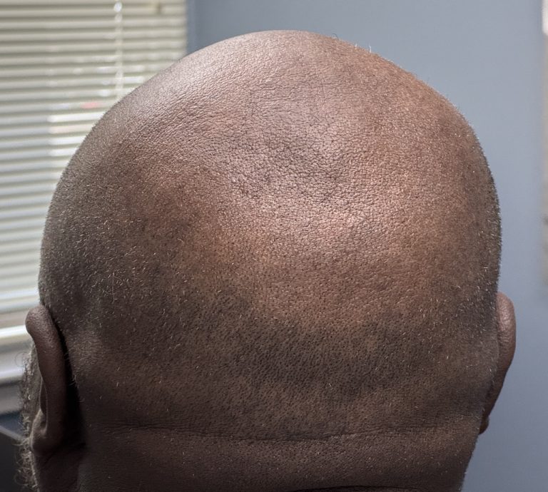 sagittal bump back view Dr Barry Eppley - Explore Plastic Surgery