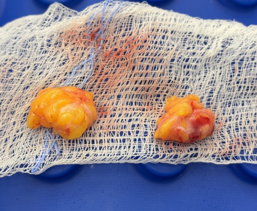 split dermal-fat graft buccal lipectomy reversal Dr Barry Eppley ...