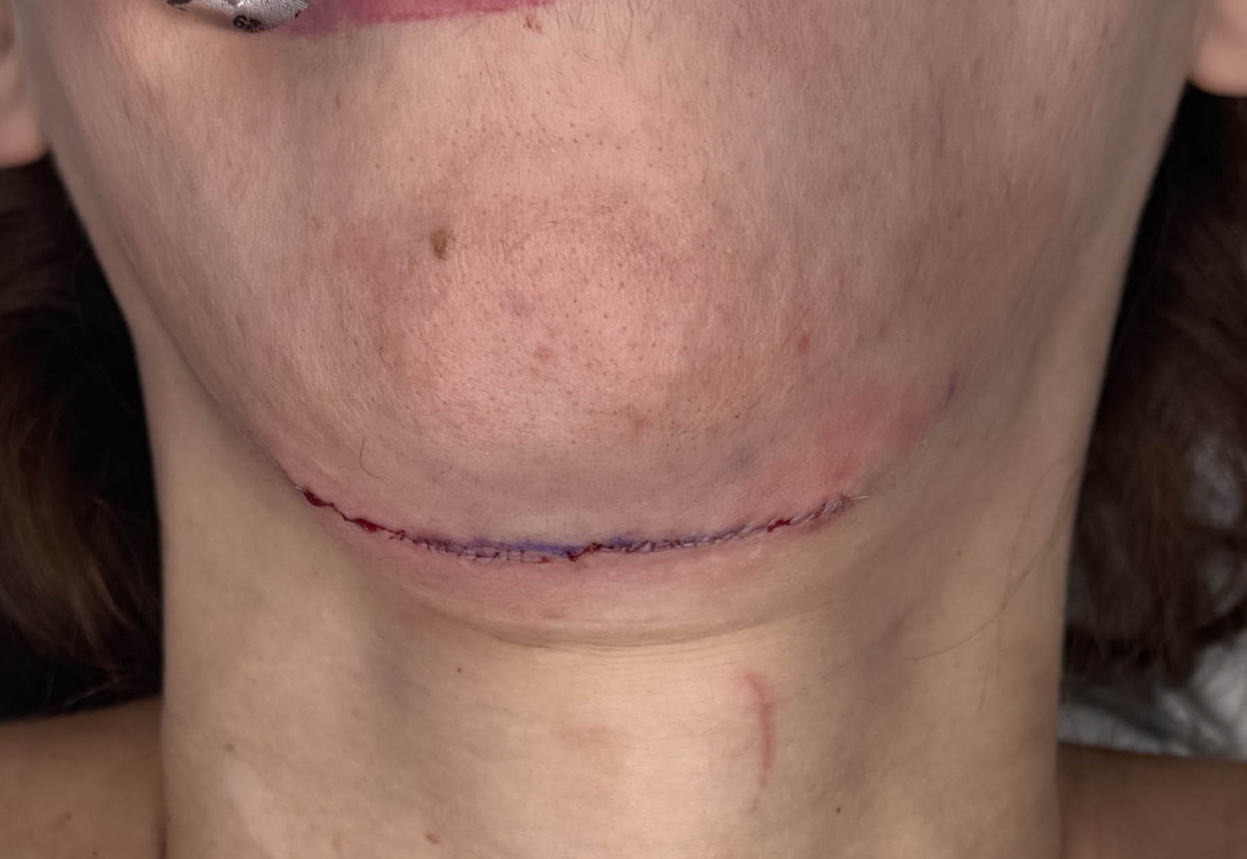 Plastic Surgery Case Study - Female Submentoplasty Scar Revision ...