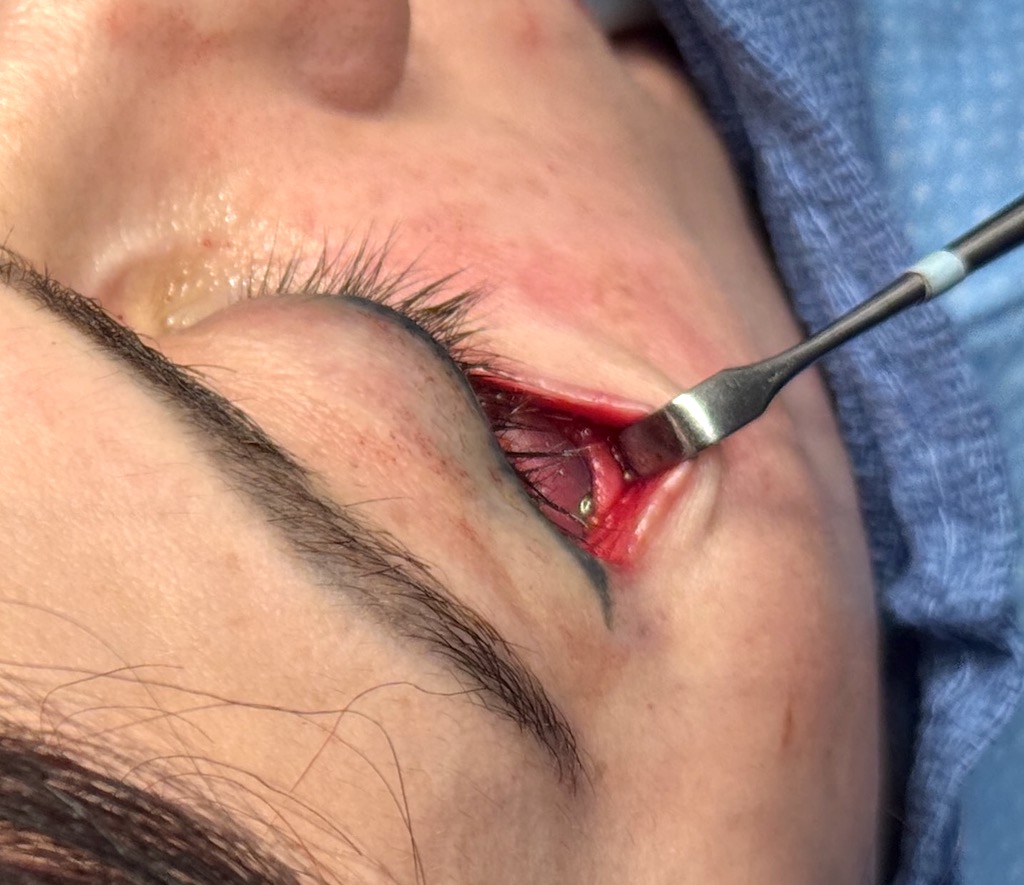 Technical Strategies - Female High Cheekbone Implants - Explore Plastic ...