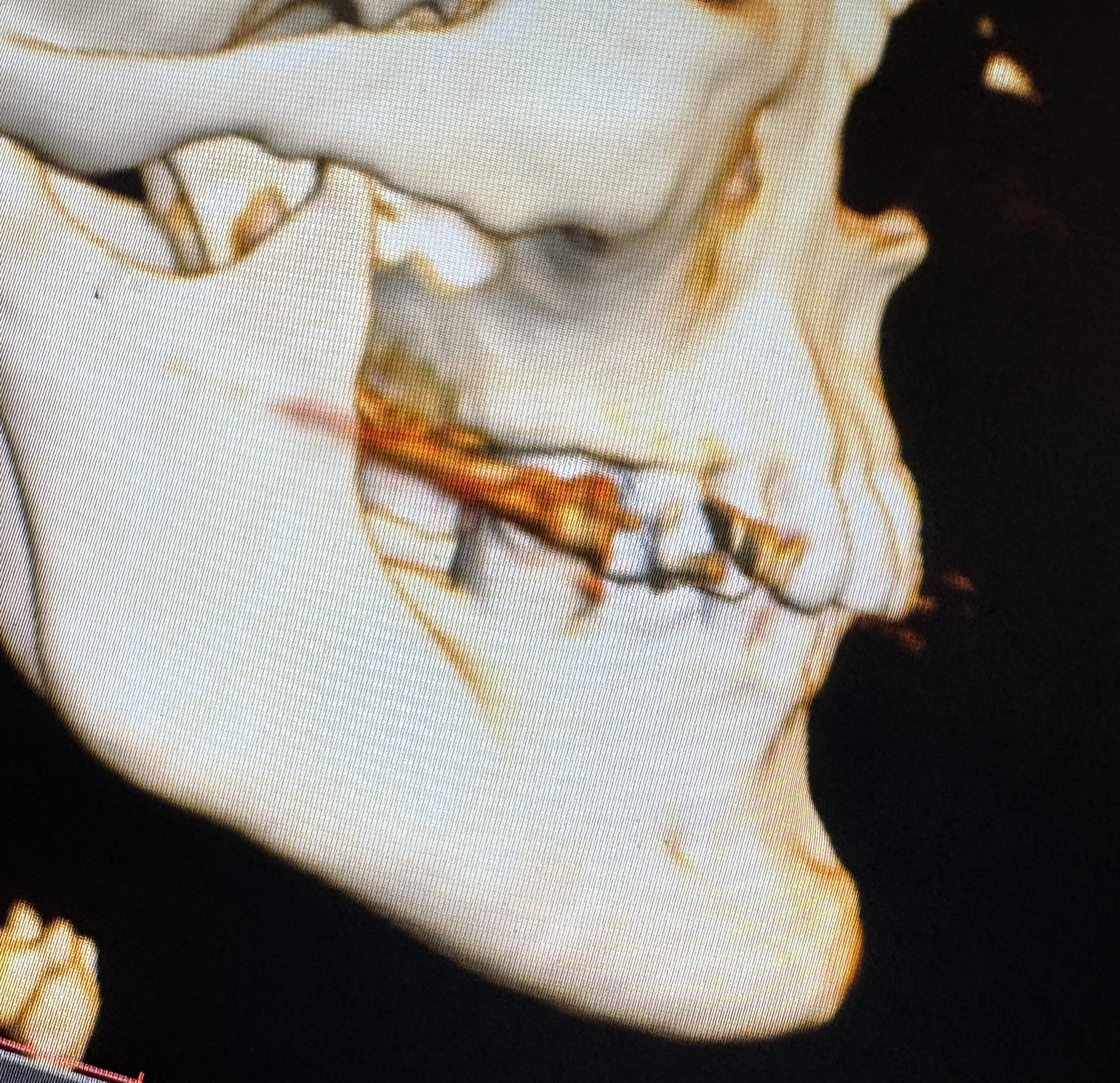 deep labiomental fold 3D CT scan side view Dr Barry Eppley - Explore ...