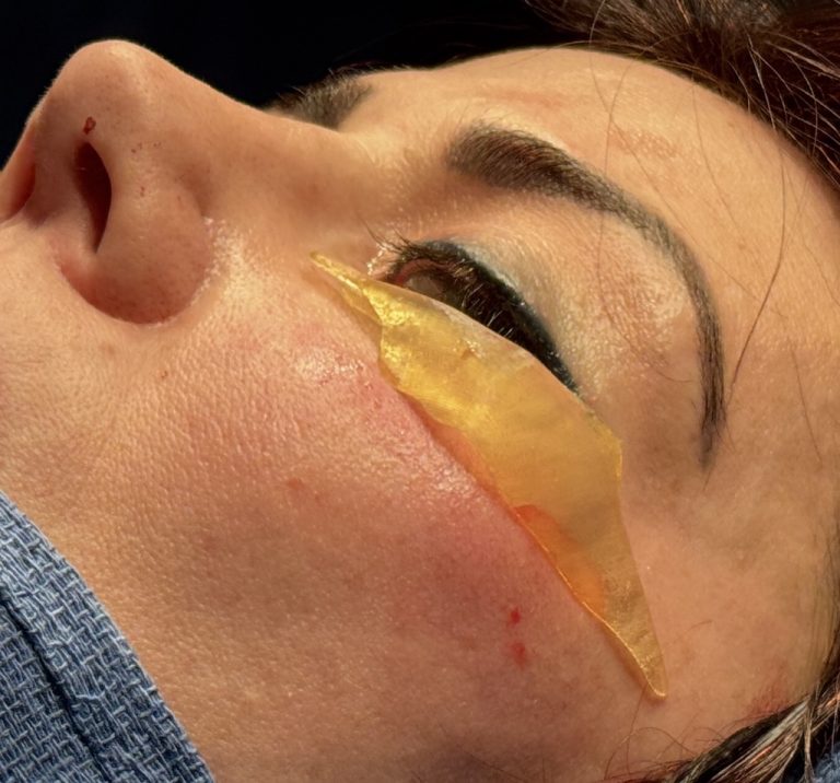 Technical Strategies - Female High Cheekbone Implants - Explore Plastic ...