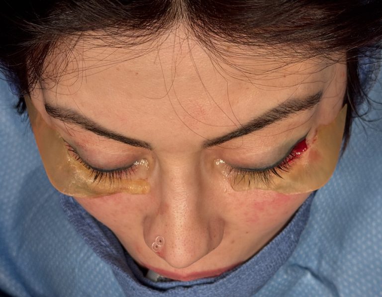 Technical Strategies - Female High Cheekbone Implants - Explore Plastic ...