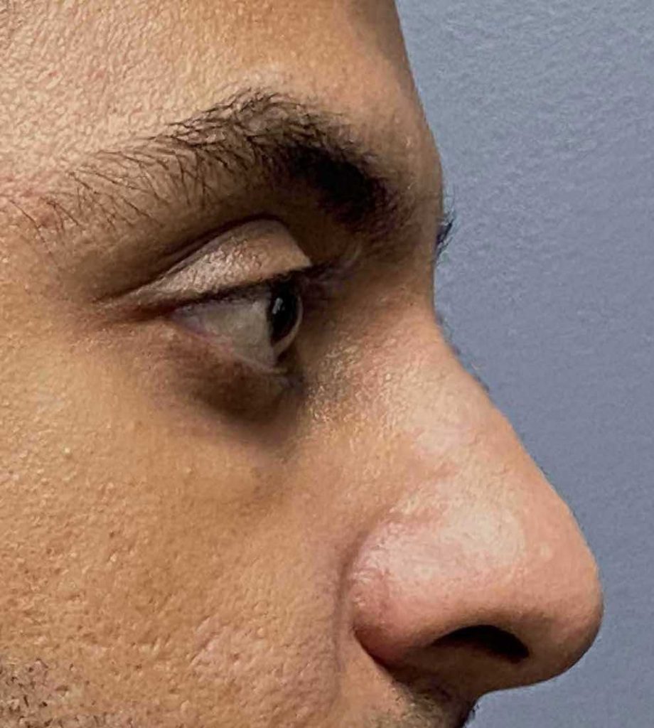 Plastic Surgery Case Study - Custom IOM (Infraorbital-Malar) Implants in the Treatment of the ...