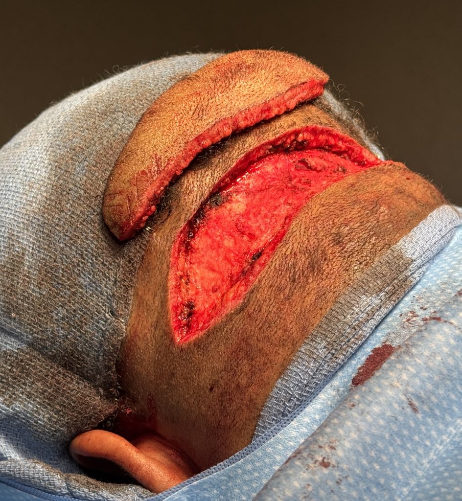 Plastic Surgery Case Study - Reduction of the Male Single Occipital ...