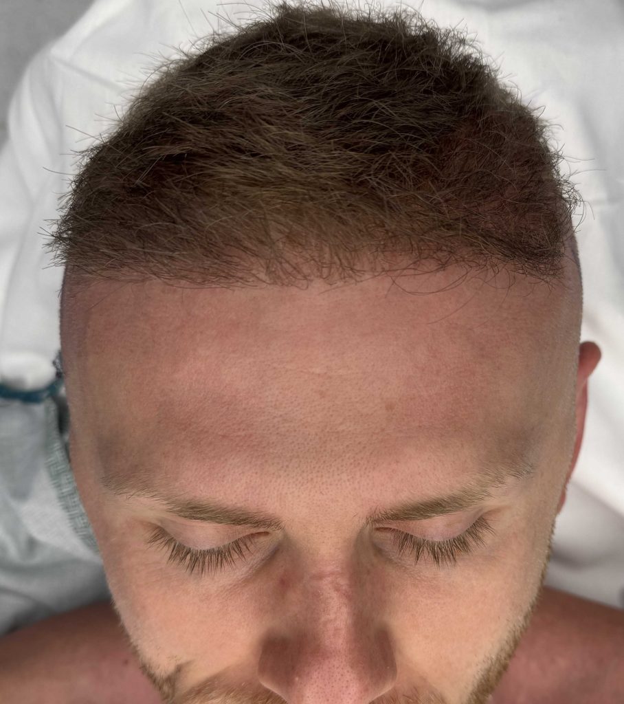 Plastic Surgery Case Study - Decreasing Bitemporal Head Width Using a ...