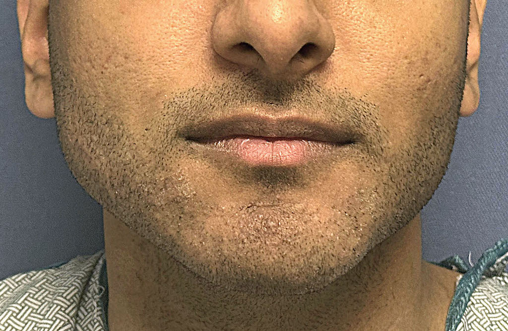 male vertical chin lengthening front 2 Dr Barry Eppley - Explore ...