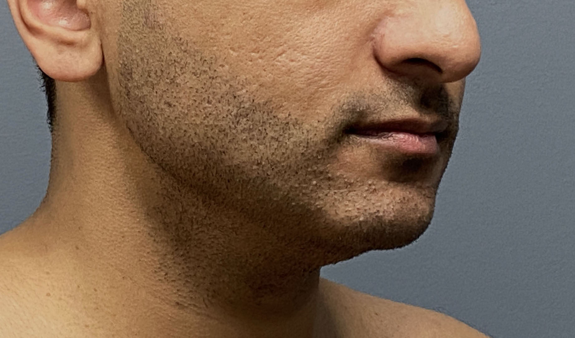 Plastic Surgery Case Study - 2nd Stage Custom Chin Implant after 1st ...