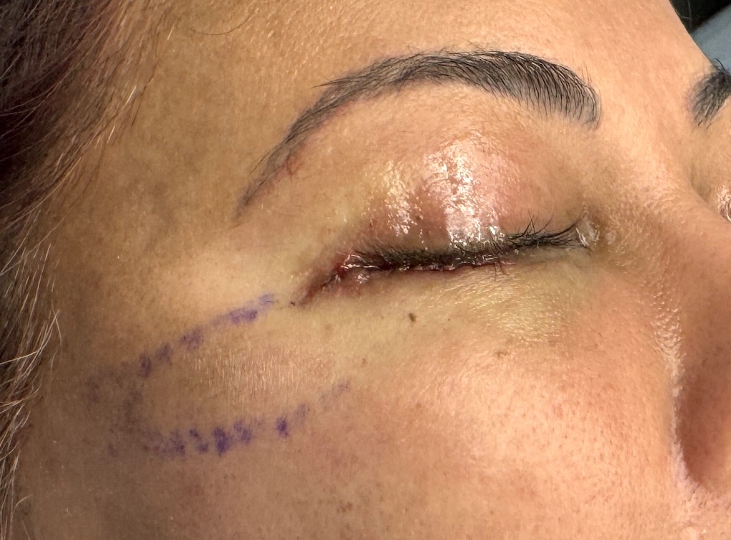 overlay cheek implant eyelid incision closure Dr Barry Eppley - Explore ...