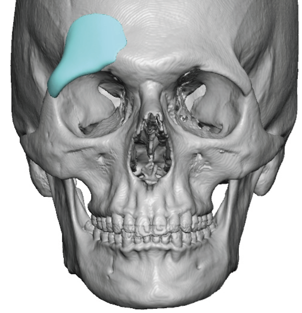 Plastic Surgery Case Study - Transpalpebral Placement of a Custom Brow ...