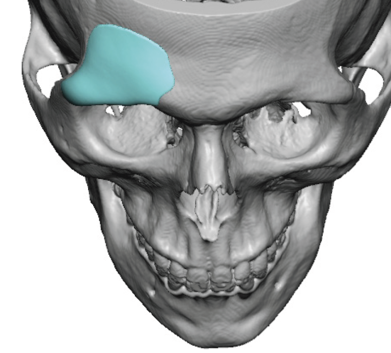 Plastic Surgery Case Study - Transpalpebral Placement of a Custom Brow ...