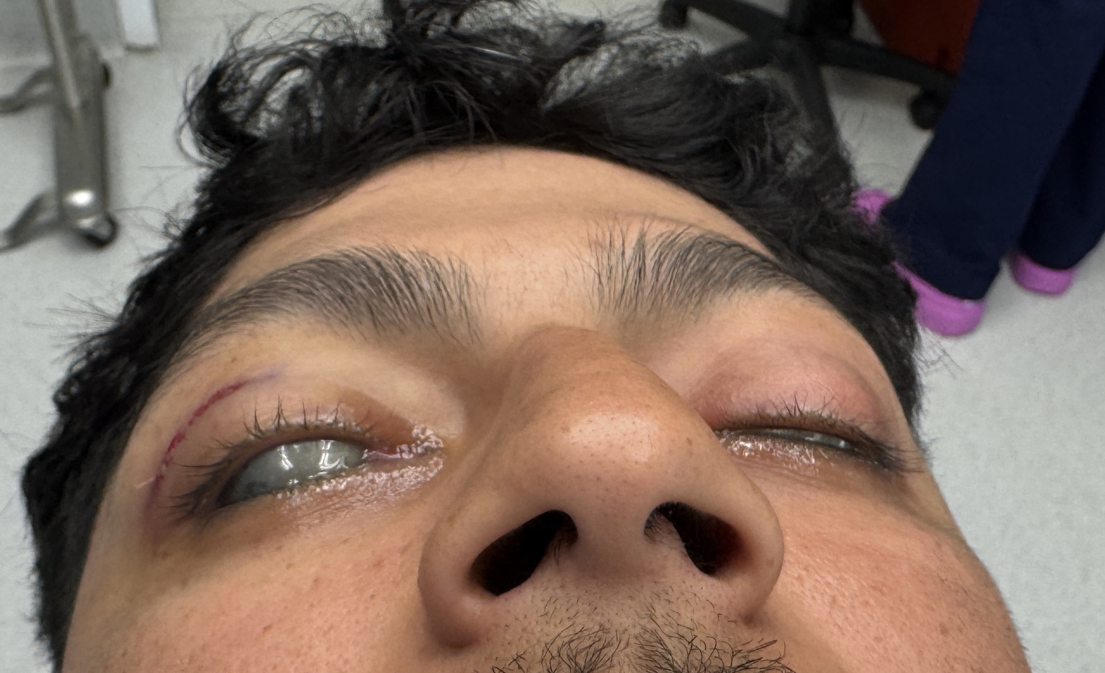 right custom forehead-brow bone implant Dr Barry Eppley - Explore ...