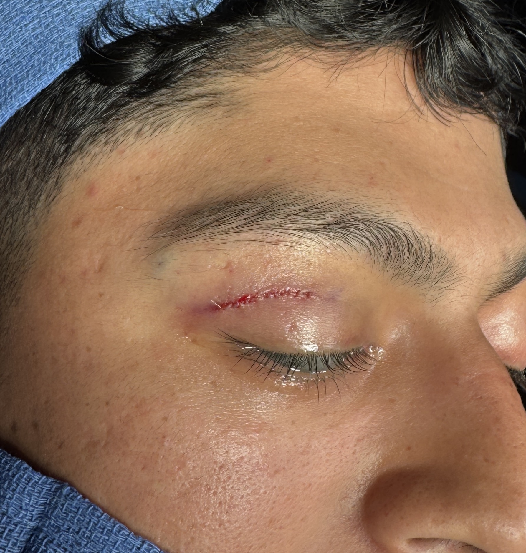 right custom forehead-brow bone implant eyelid incision closure Dr ...