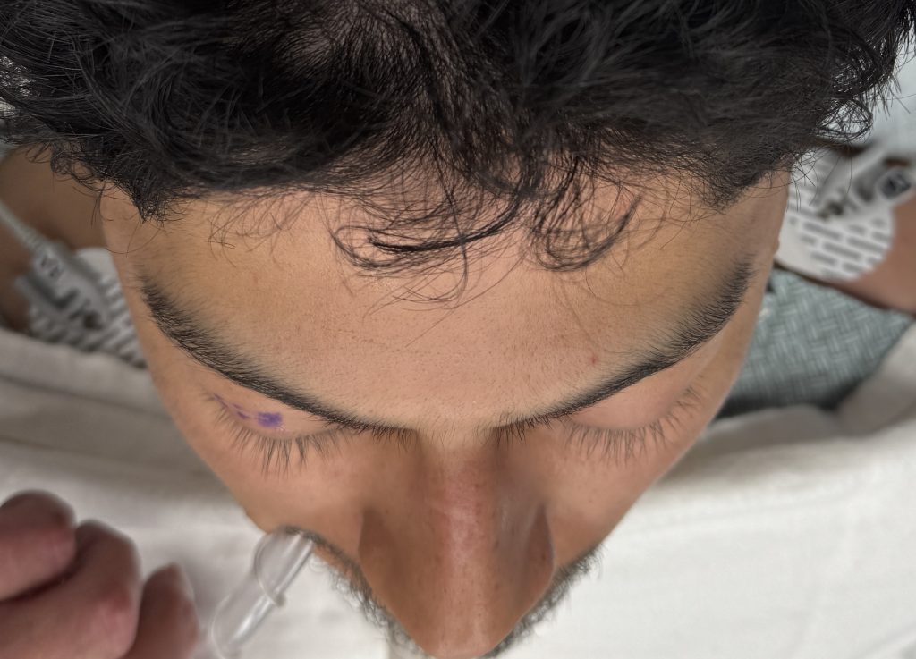 Plastic Surgery Case Study - Transpalpebral Placement of a Custom Brow ...