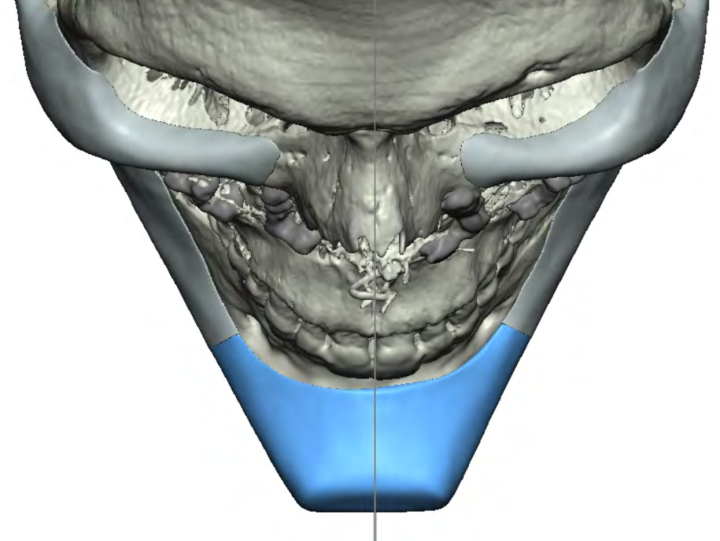 Plastic Surgery Case Study - Custom Medpor Square Chin Implant ...