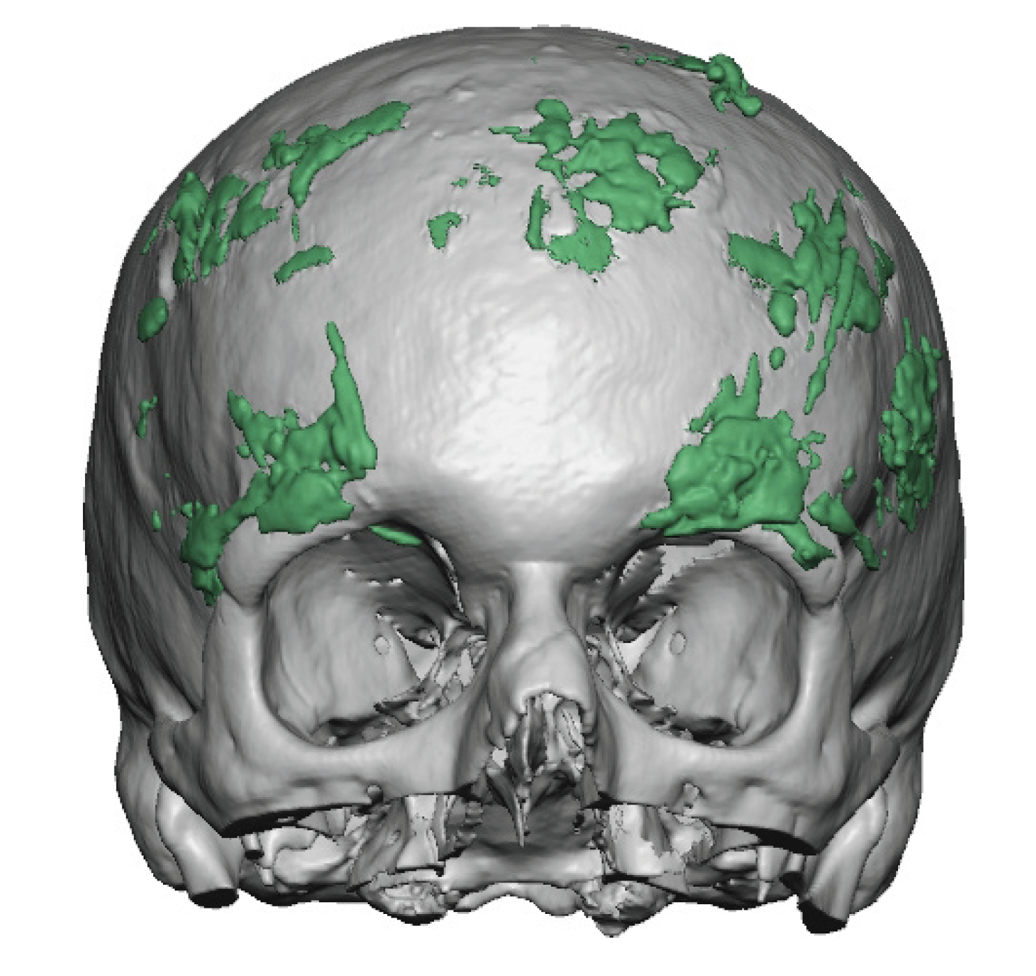 Radiesse injectable filler for bony skull contour irregularities 3D CT ...