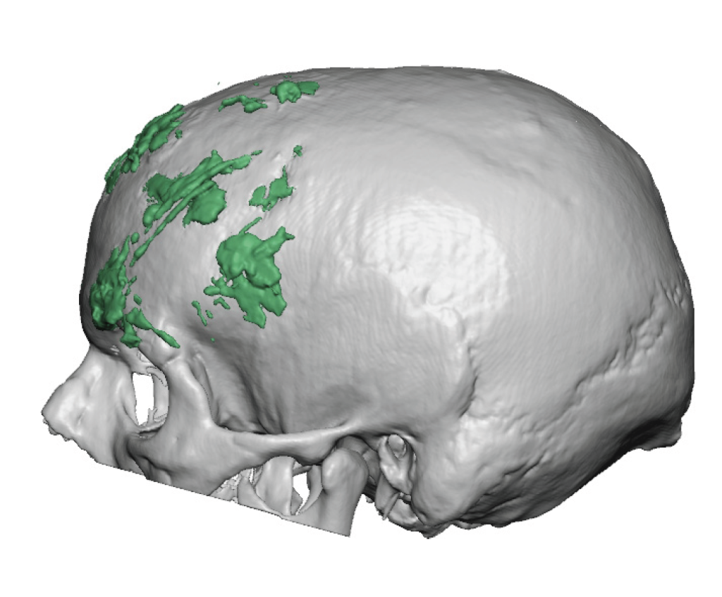 Plastic Surgery Case Study - Custom Skull Implant for Creating a Smooth ...