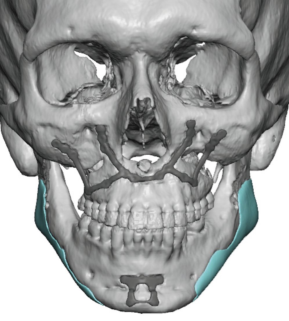 Plastic Surgery Case Study - Removal Of Bulky Medpor Jawline Implants ...