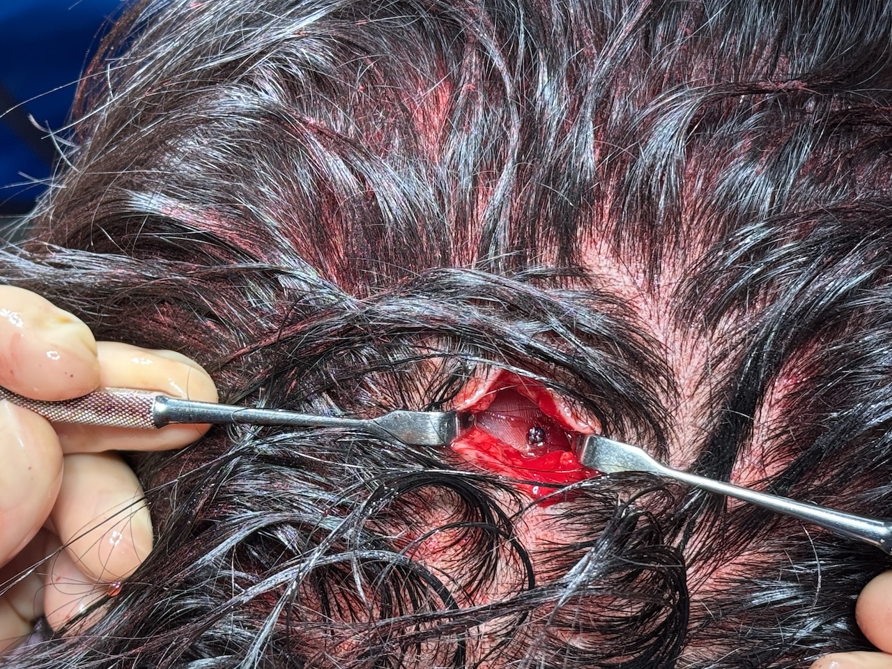 Plastic Surgery Case Study: Large Four-Piece Custom Skull Implant for ...