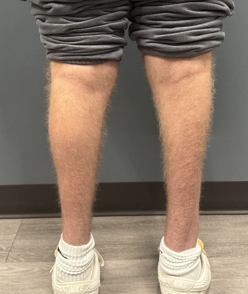 Plastic Surgery Case Study - Custom Calf Implants in Congenital ...