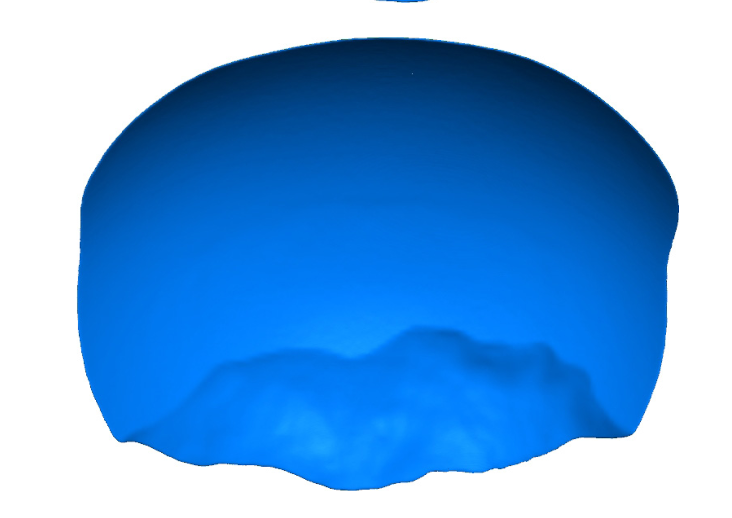 Plastic Surgery Case Study - Secondary Forehead and Back of Head ...