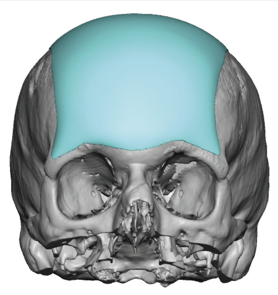 Plastic Surgery Case Study - Custom Skull Implant for Creating a Smooth ...