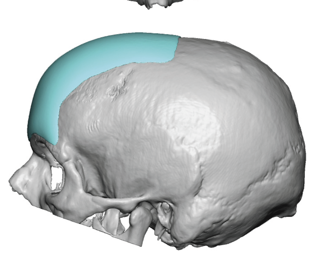 Plastic Surgery Case Study - Custom Skull Implant for Creating a Smooth ...