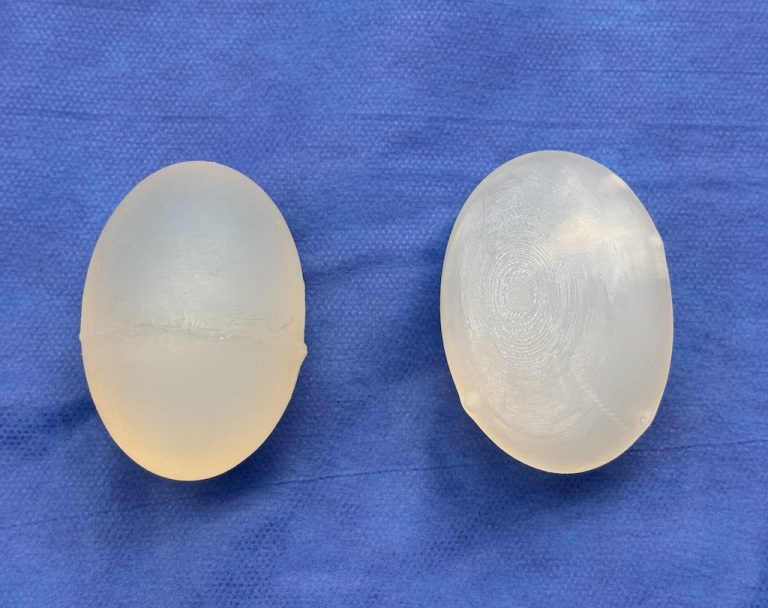 Plastic Surgery Case Study - Custom Testicle Implant Replacements For A ...