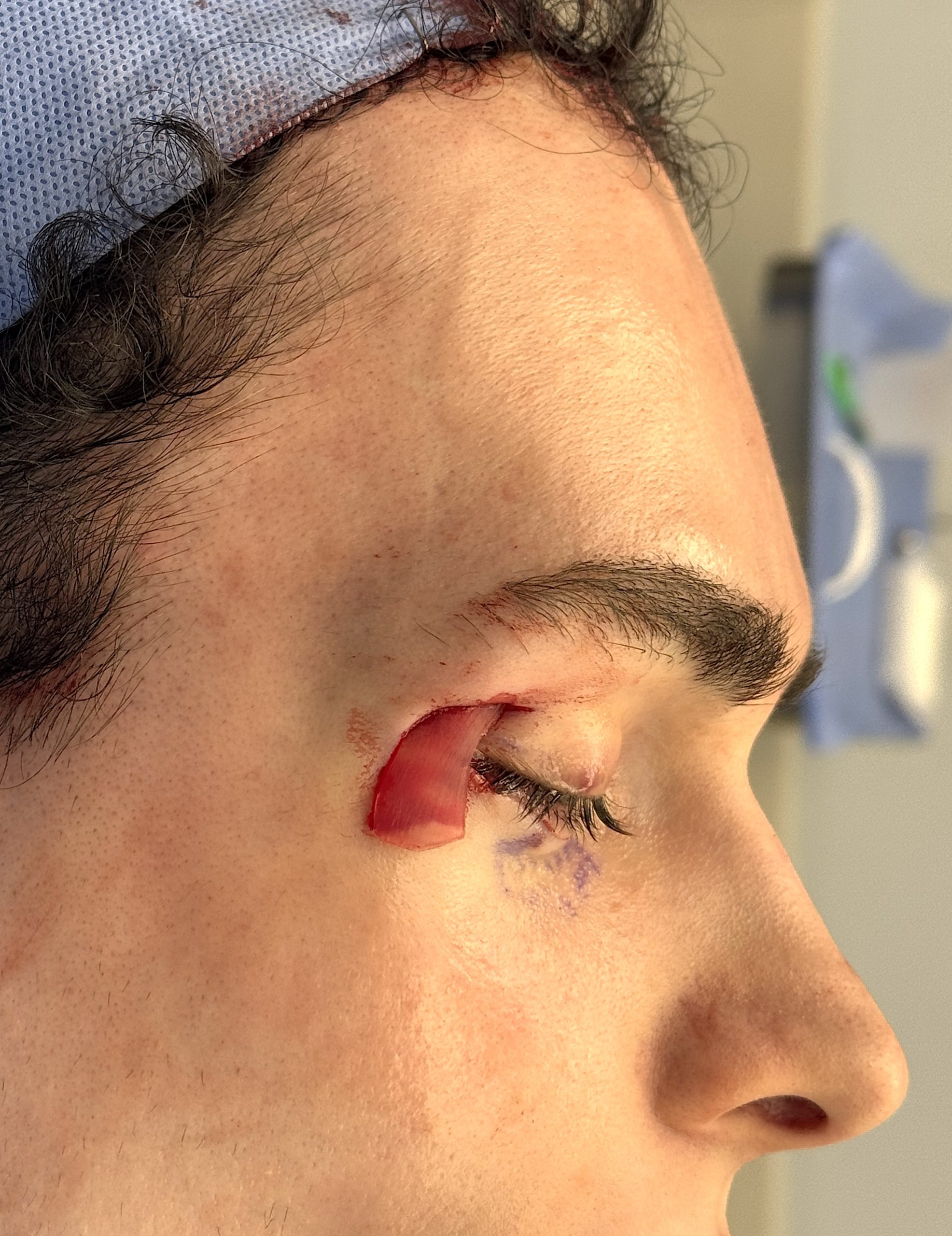 custom brow bone implant placement riight eyelid incision Dr Barry ...