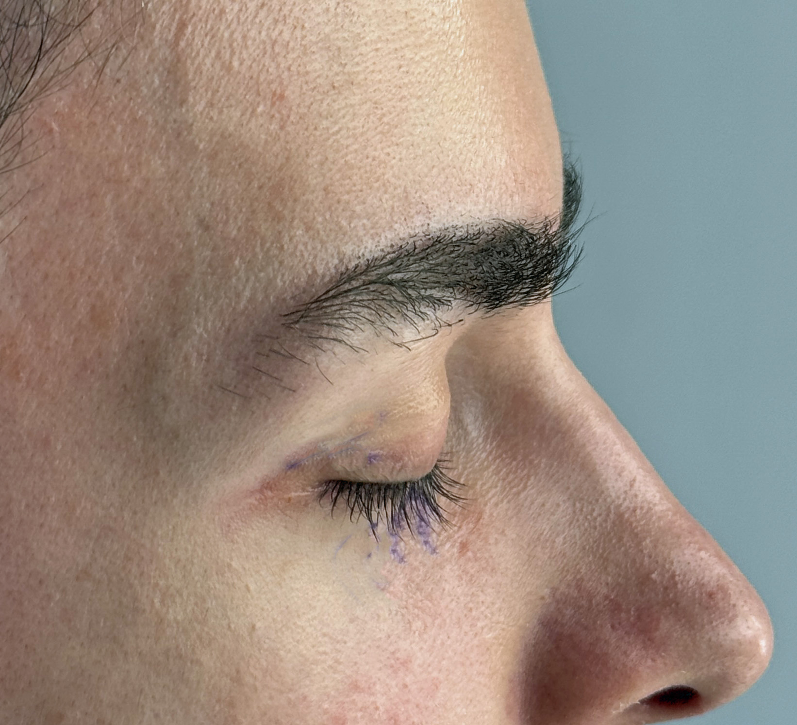 custom brow bone implants and the Hunter Eyte Look side 1 Dr Barry ...