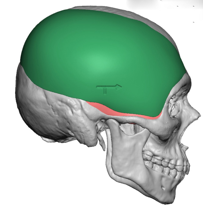 Plastic Surgery Case Study - Secondary Forehead and Back of Head ...