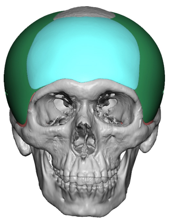 Plastic Surgery Case Study - Secondary Forehead and Back of Head ...