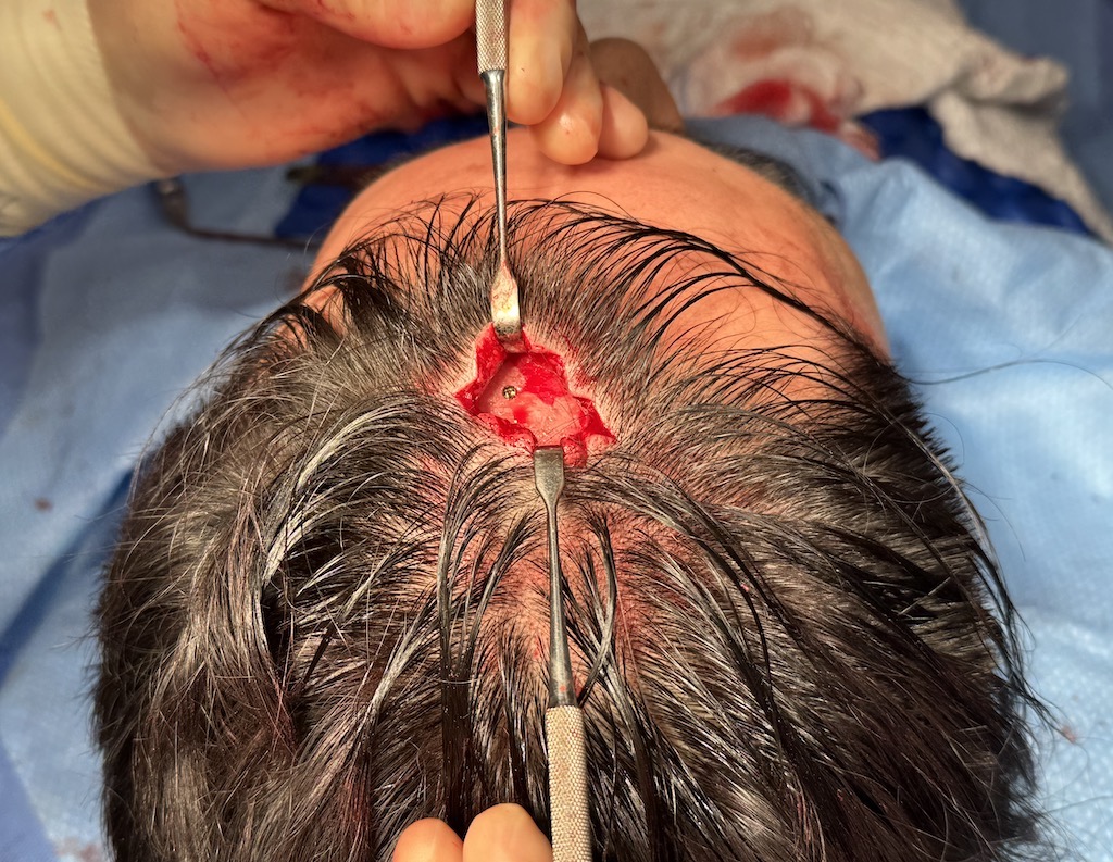 Plastic Surgery Case Study - Secondary Forehead and Back of Head ...