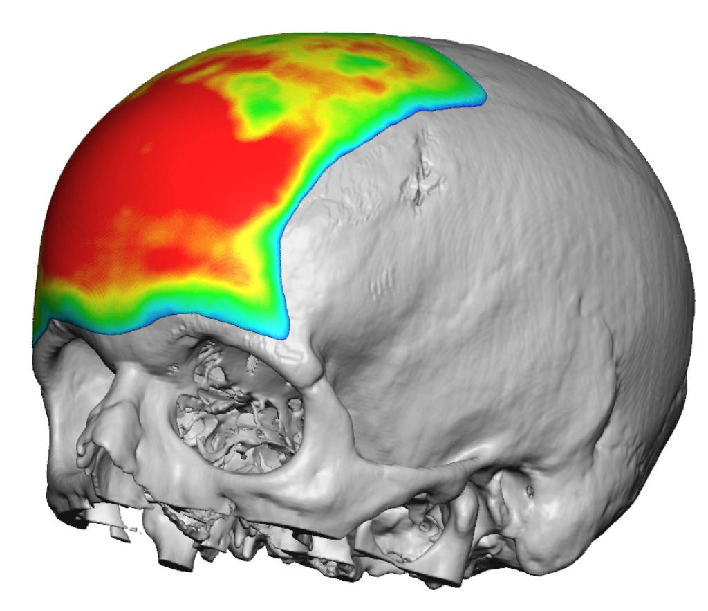 Plastic Surgery Case Study - Custom Skull Implant for Creating a Smooth ...