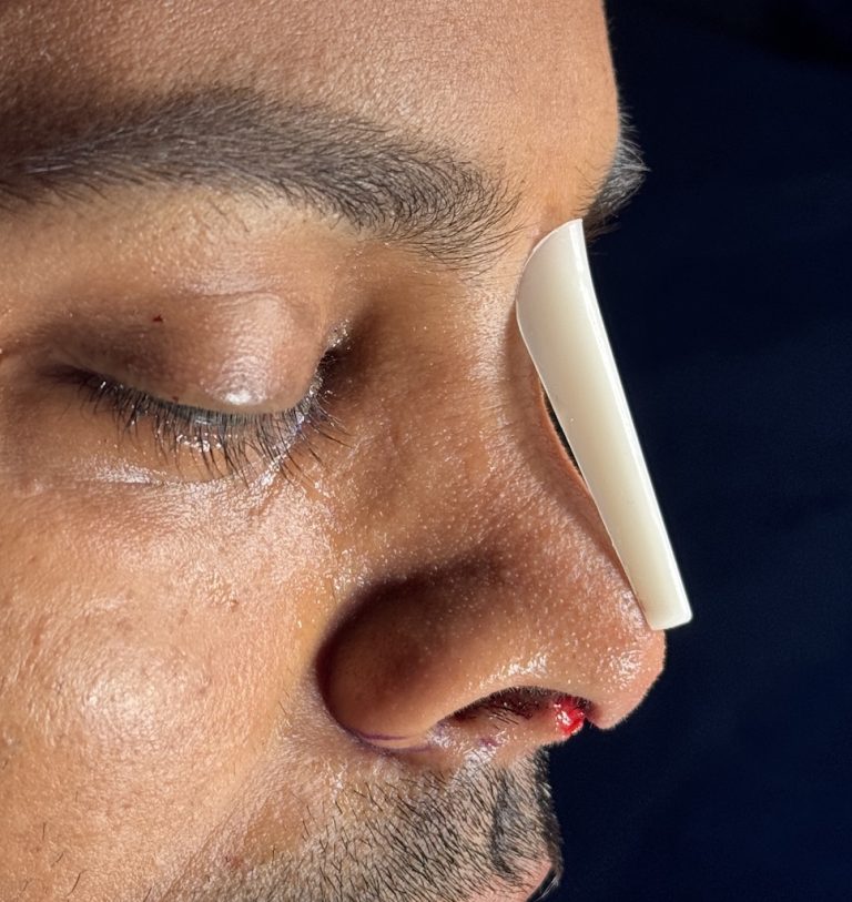 Plastic Surgery Case Study - Reshaping the Male Low Bridged Nose with ...