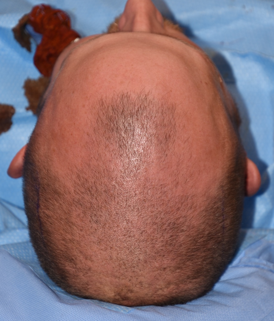 Ear Protrusions After Temporal Reduction Top View Dr Barry Eppley