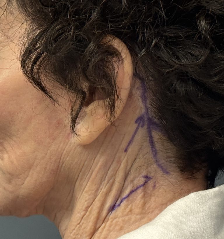 Technical Strategies - The Extended Occipital Hairline Incision In ...