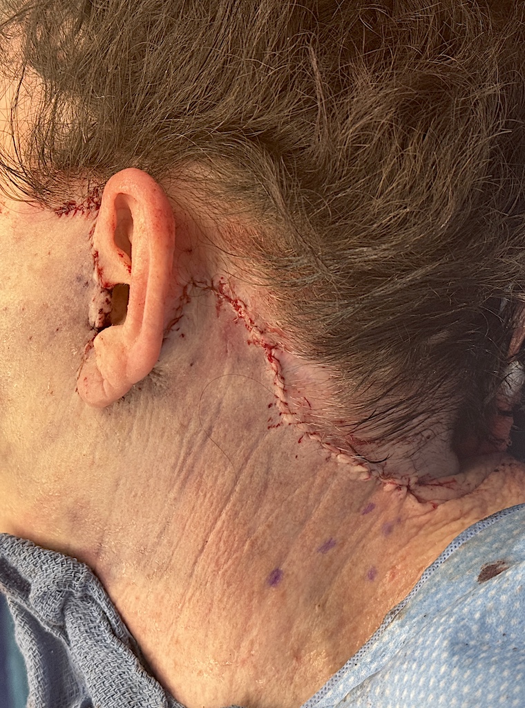 extended occipital hairline incision closure Dr Barry Eppley - Explore ...