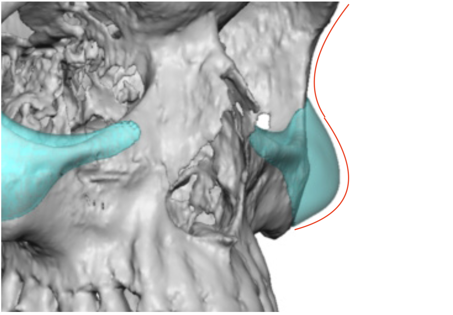 Use of the Ogee Curve in Custom Cheek Implant Designs - Explore Plastic ...
