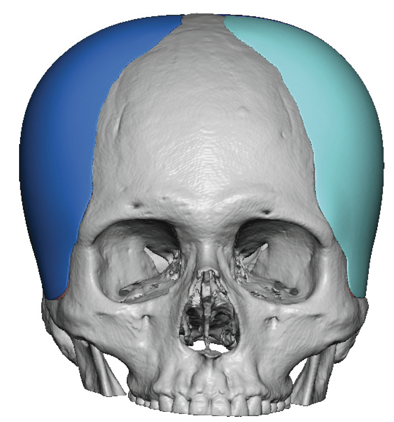 large 4 piece custom head widening implants design front view Dr Barry ...